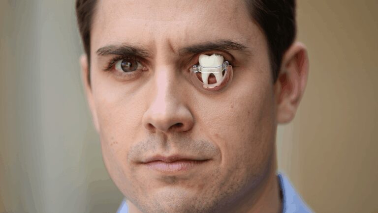 Tooth implanted in 34-year-old's eye restores vision after 20 years ...